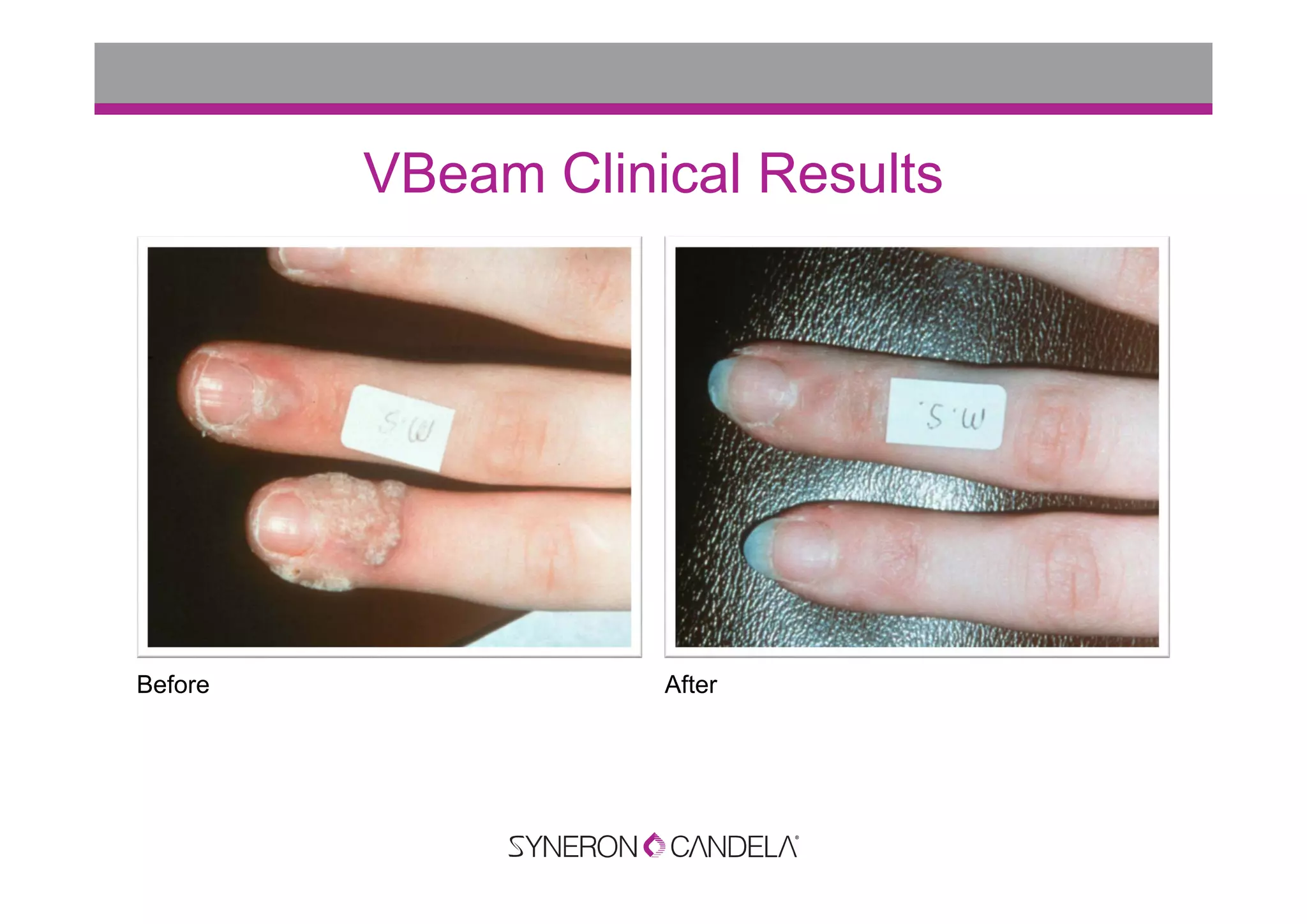 VBeam Before & After | PDF | Skin and Dermatology | Diseases and Conditions