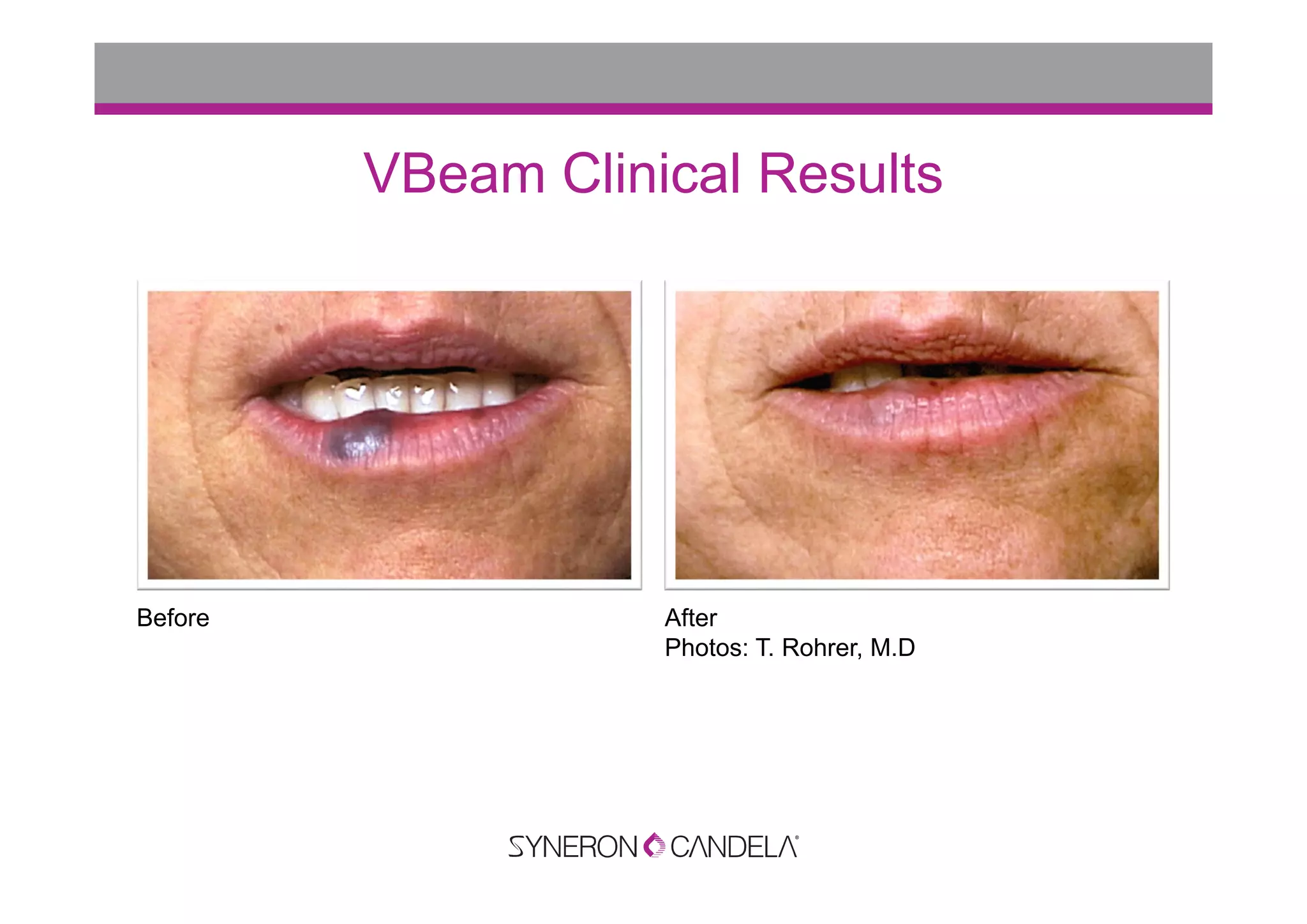 VBeam Before & After | PDF | Skin and Dermatology | Diseases and Conditions