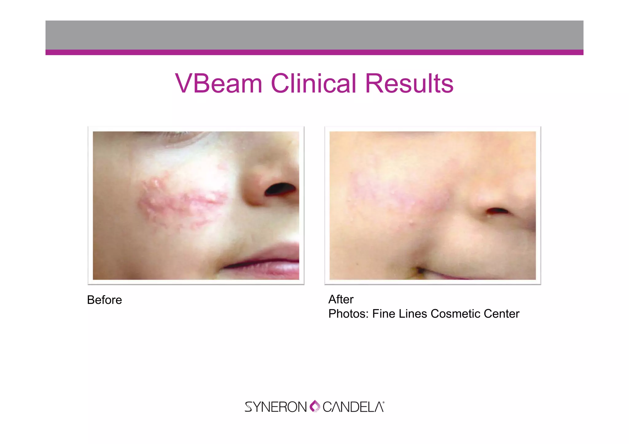 VBeam Before & After | PDF | Skin and Dermatology | Diseases and Conditions