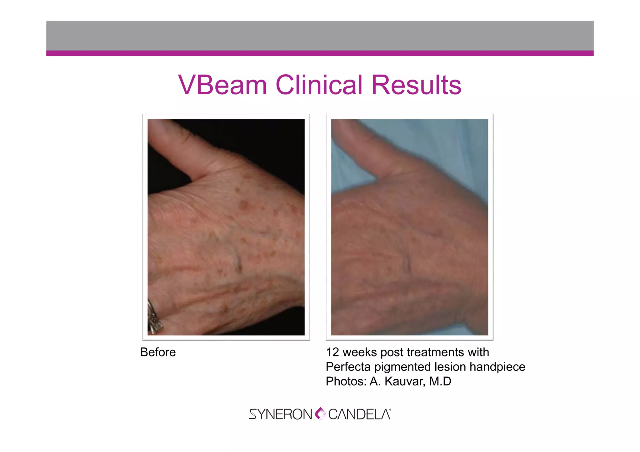 VBeam Before & After | PDF | Skin and Dermatology | Diseases and Conditions