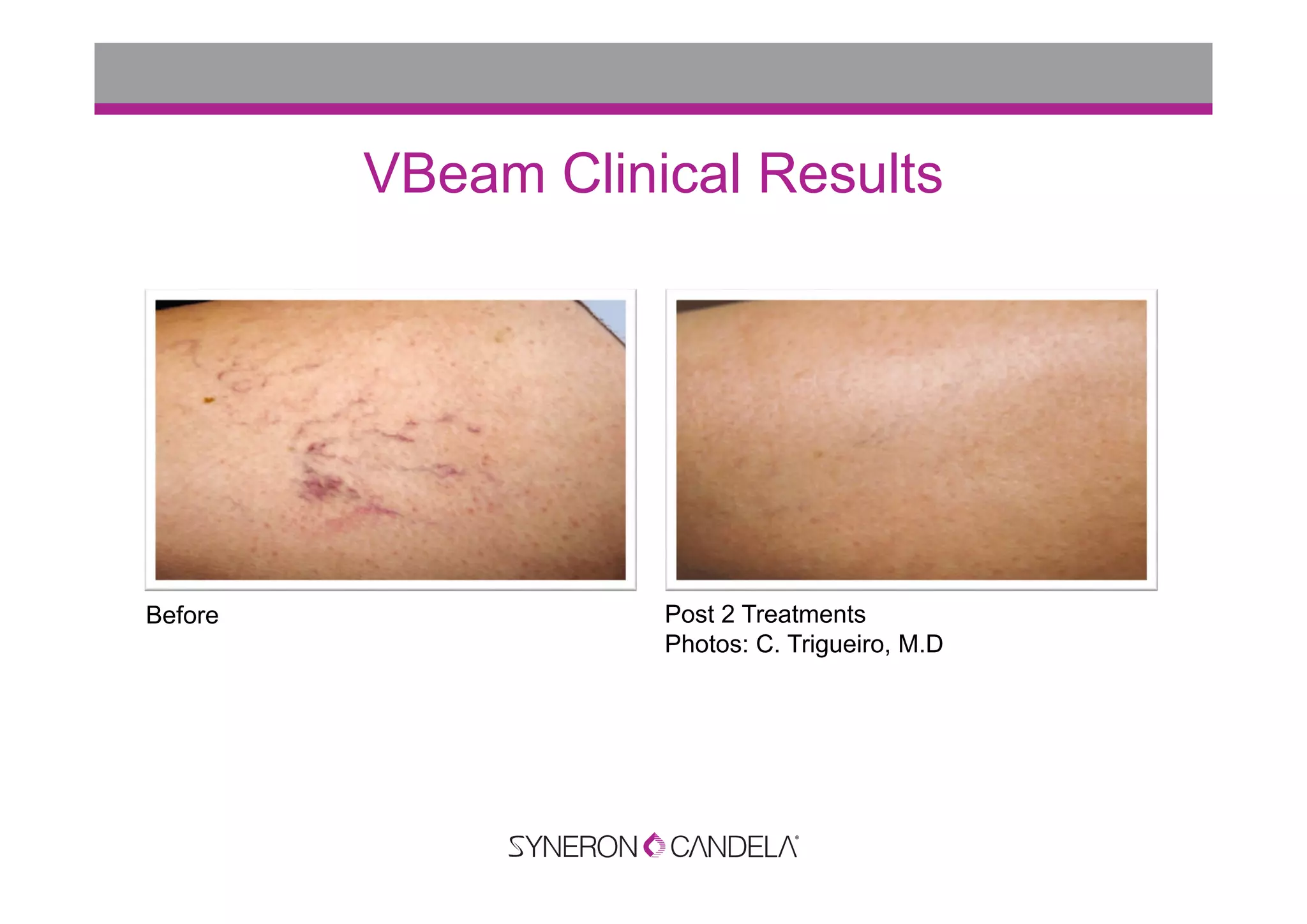 VBeam Before & After | PDF | Skin and Dermatology | Diseases and Conditions