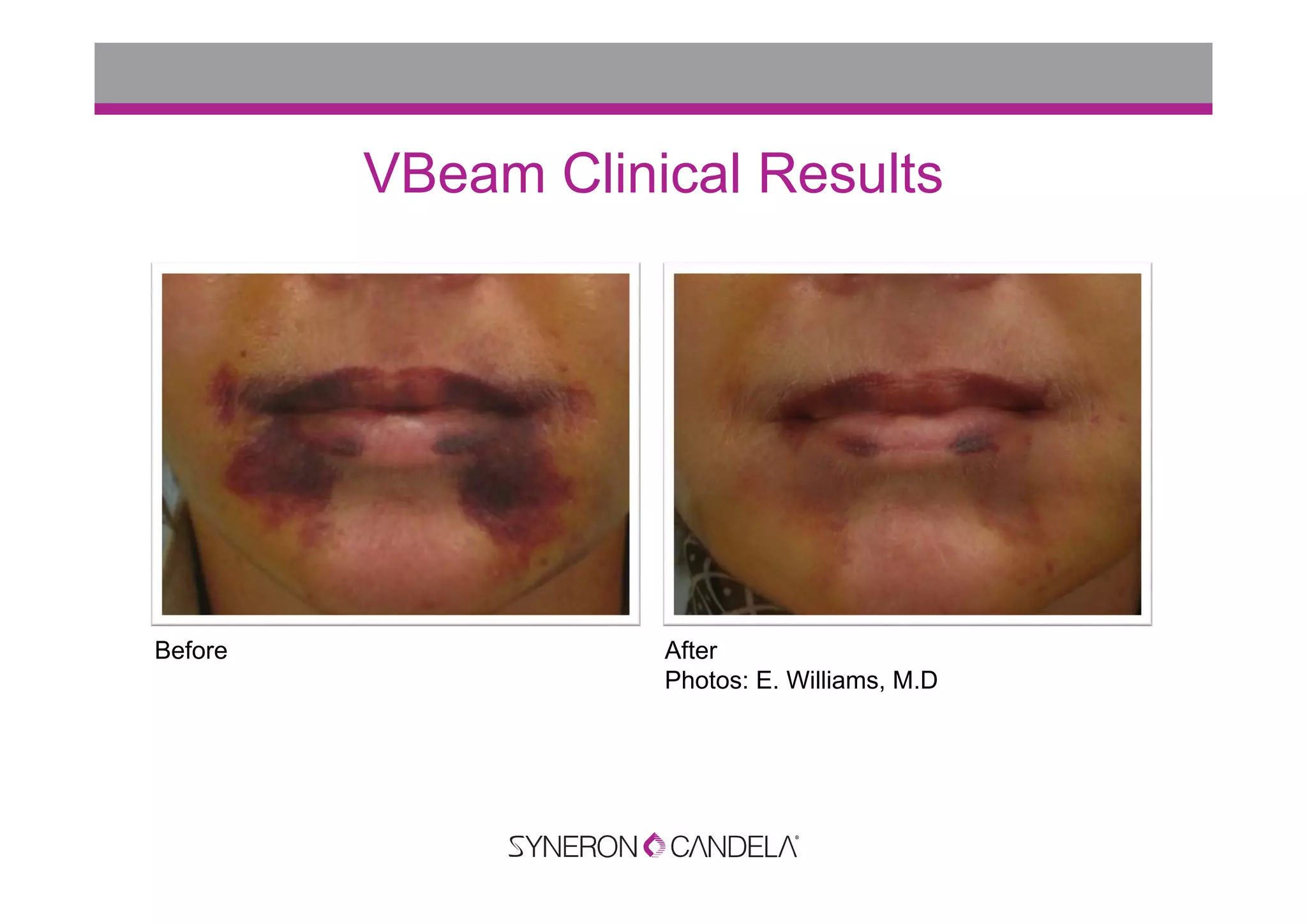 VBeam Before & After | PDF | Skin and Dermatology | Diseases and Conditions