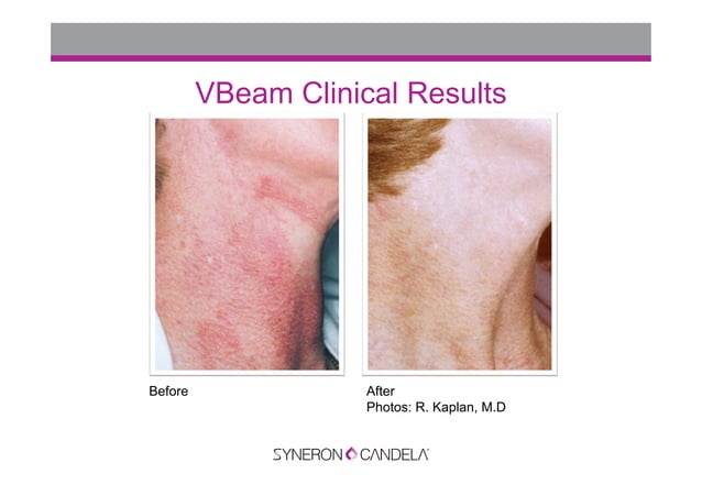 VBeam Before & After | PDF | Skin and Dermatology | Diseases and Conditions