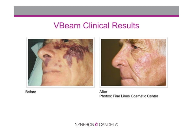 VBeam Before & After | PDF | Skin and Dermatology | Diseases and Conditions