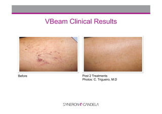 VBeam Before & After | PDF | Skin and Dermatology | Diseases and Conditions