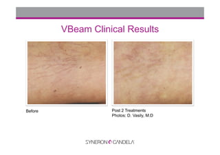 VBeam Before & After | PDF | Skin and Dermatology | Diseases and Conditions