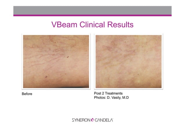 VBeam Before & After | PDF | Skin and Dermatology | Diseases and Conditions