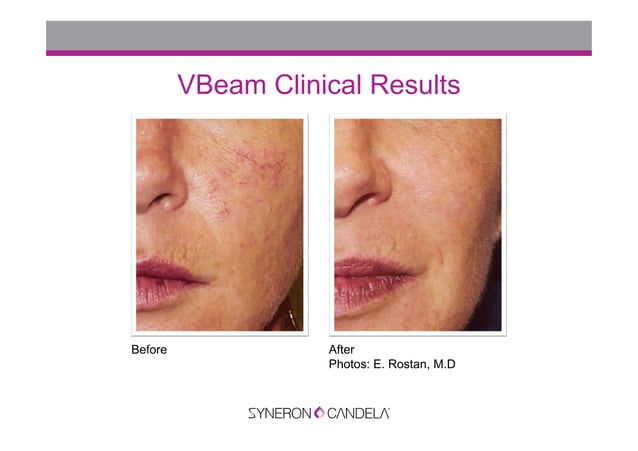VBeam Before & After | PDF | Skin and Dermatology | Diseases and Conditions