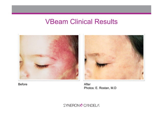 VBeam Before & After | PDF | Skin and Dermatology | Diseases and Conditions