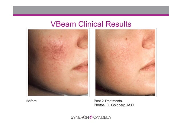 VBeam Before & After | PDF | Skin and Dermatology | Diseases and Conditions