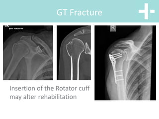 Common fractures and how to treat them | PPTX