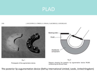 Removing Acetabular Cup | PPT