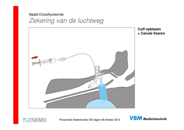 VBM Cricothyrotomie & Supra glottische luchtweg