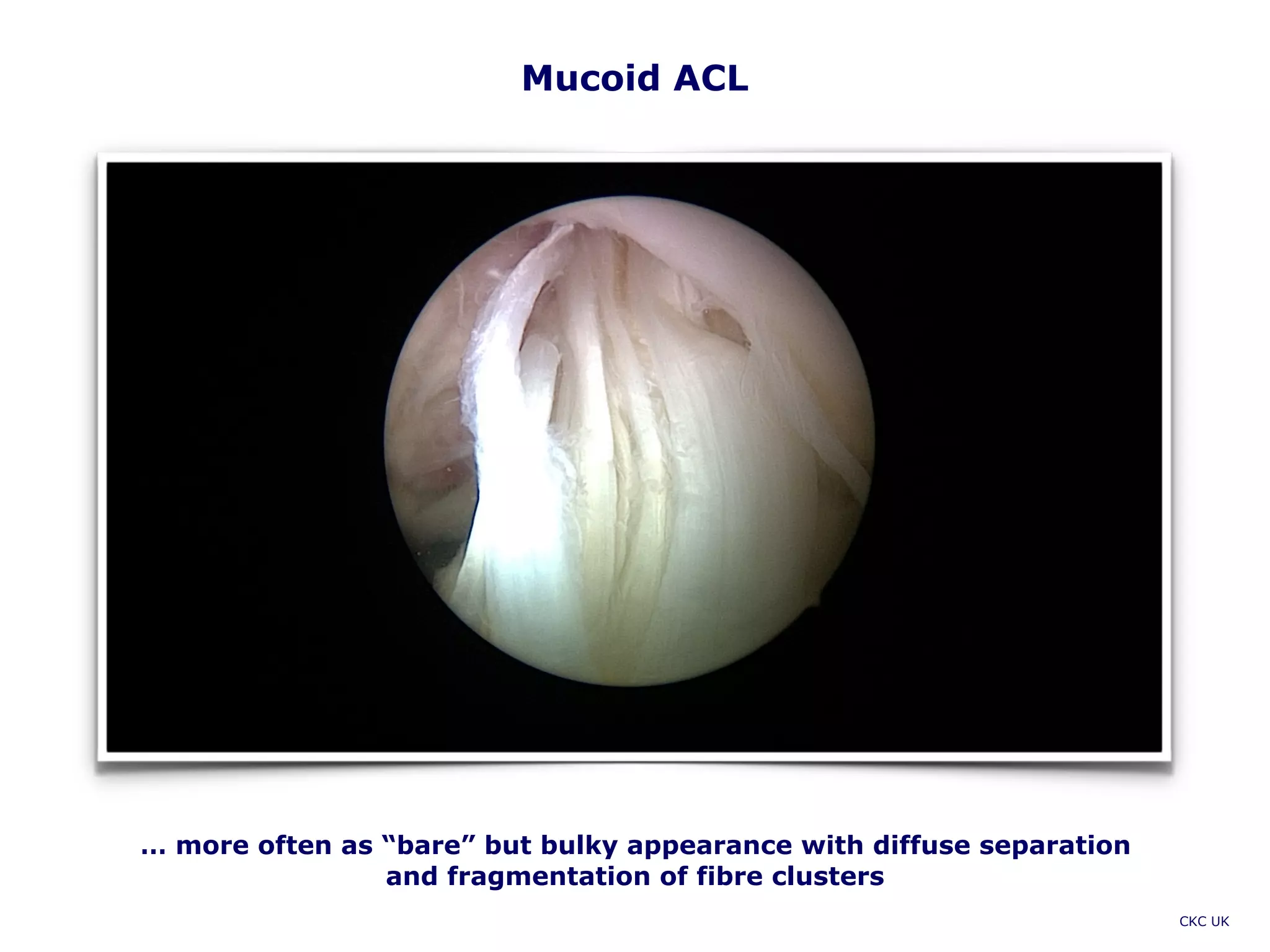 Mucoid ACL Degeneration | PDF
