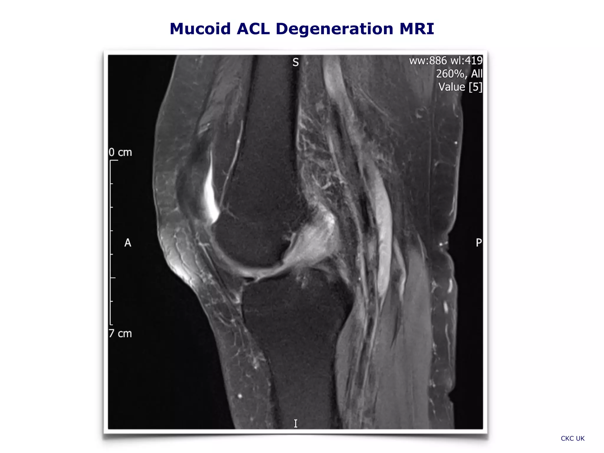 Mucoid ACL Degeneration | PPT