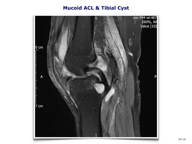 Mucoid ACL Degeneration | PPT
