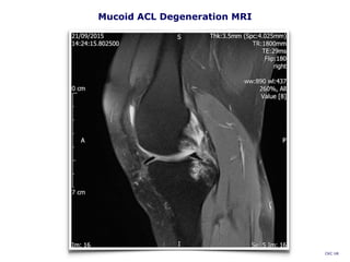 Mucoid ACL Degeneration | PDF