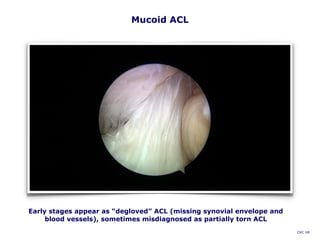 Mucoid ACL Degeneration | PDF