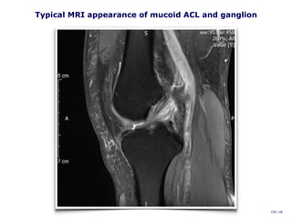 Mucoid ACL Degeneration | PDF