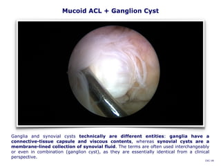 Mucoid ACL Degeneration | PDF