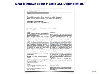 Mucoid ACL Degeneration | PDF