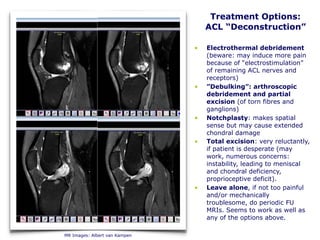 Mucoid ACL Degeneration | PDF