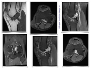 Mucoid ACL Degeneration | PDF