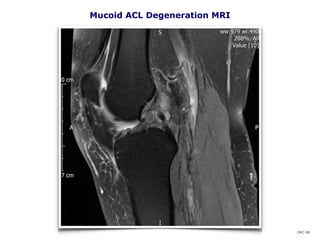 Mucoid ACL Degeneration | PDF