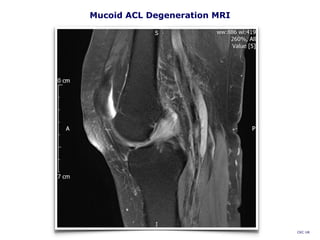 Mucoid ACL Degeneration | PDF