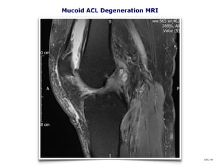 Mucoid ACL Degeneration | PDF