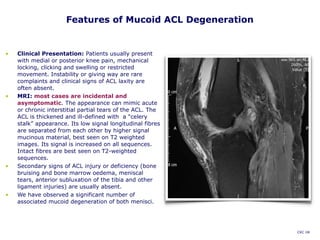 V Bobic - Mucoid ACL - ACL SG St Kitts 2023 As presented.pdf