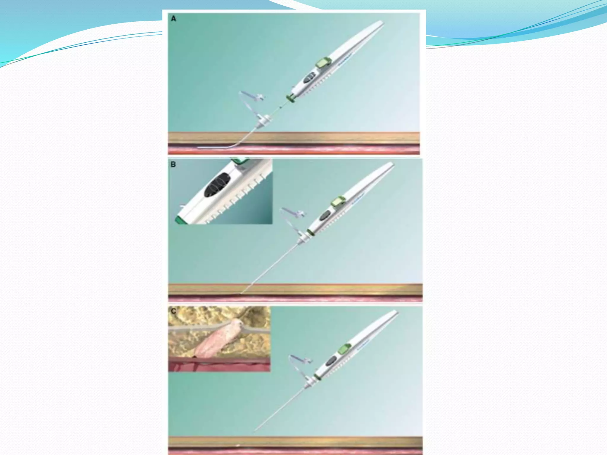 Vascular Closure Devices | PPTX