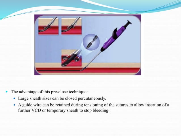 Vascular Closure Devices | PPTX | First Aid | Injuries