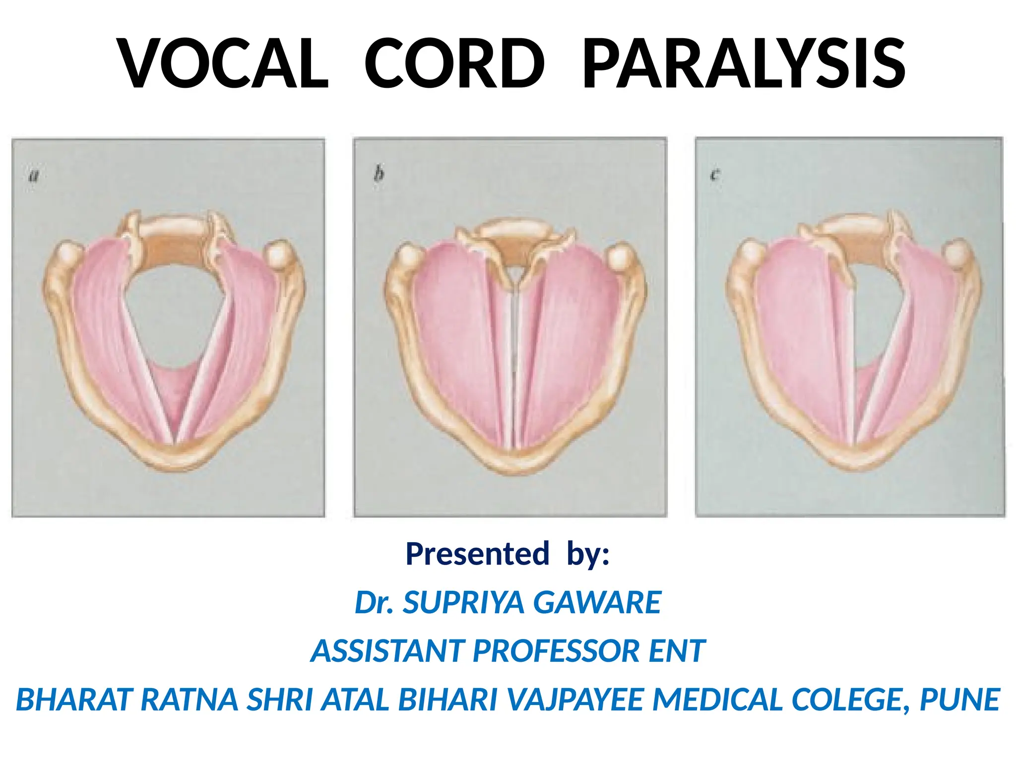 vocal cord palsy larynx - short lec.pptx