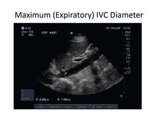 vdocument.in_ivc-ultrasound.pptx