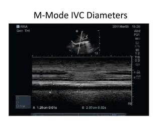 vdocument.in_ivc-ultrasound.pptx
