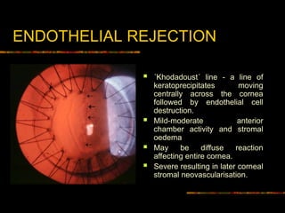 vdocument.in_corneal-graft-rejection-and-graft-failure.ppt