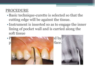 vdocuments.net_surgical-periodontal-therapy-56ebcbc25be52.ppt | Oral ...