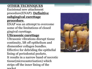 vdocuments.net_surgical-periodontal-therapy-56ebcbc25be52.ppt