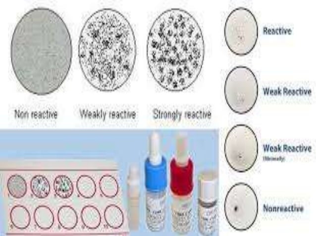 VDRL Test for Syphilis | PPTX | Infectious Diseases | Diseases and ...