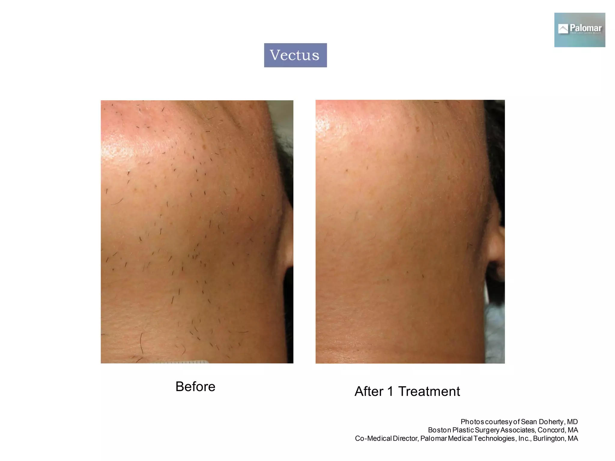 Vectus diode laser iml | PDF