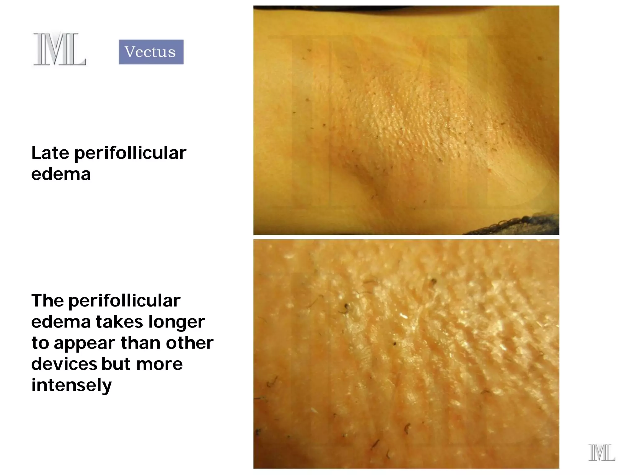 Vectus diode laser iml | PDF