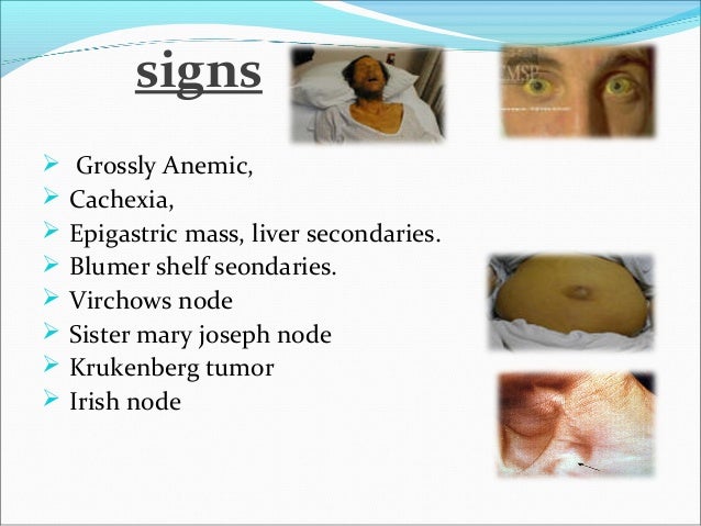 carcinoma of stomach