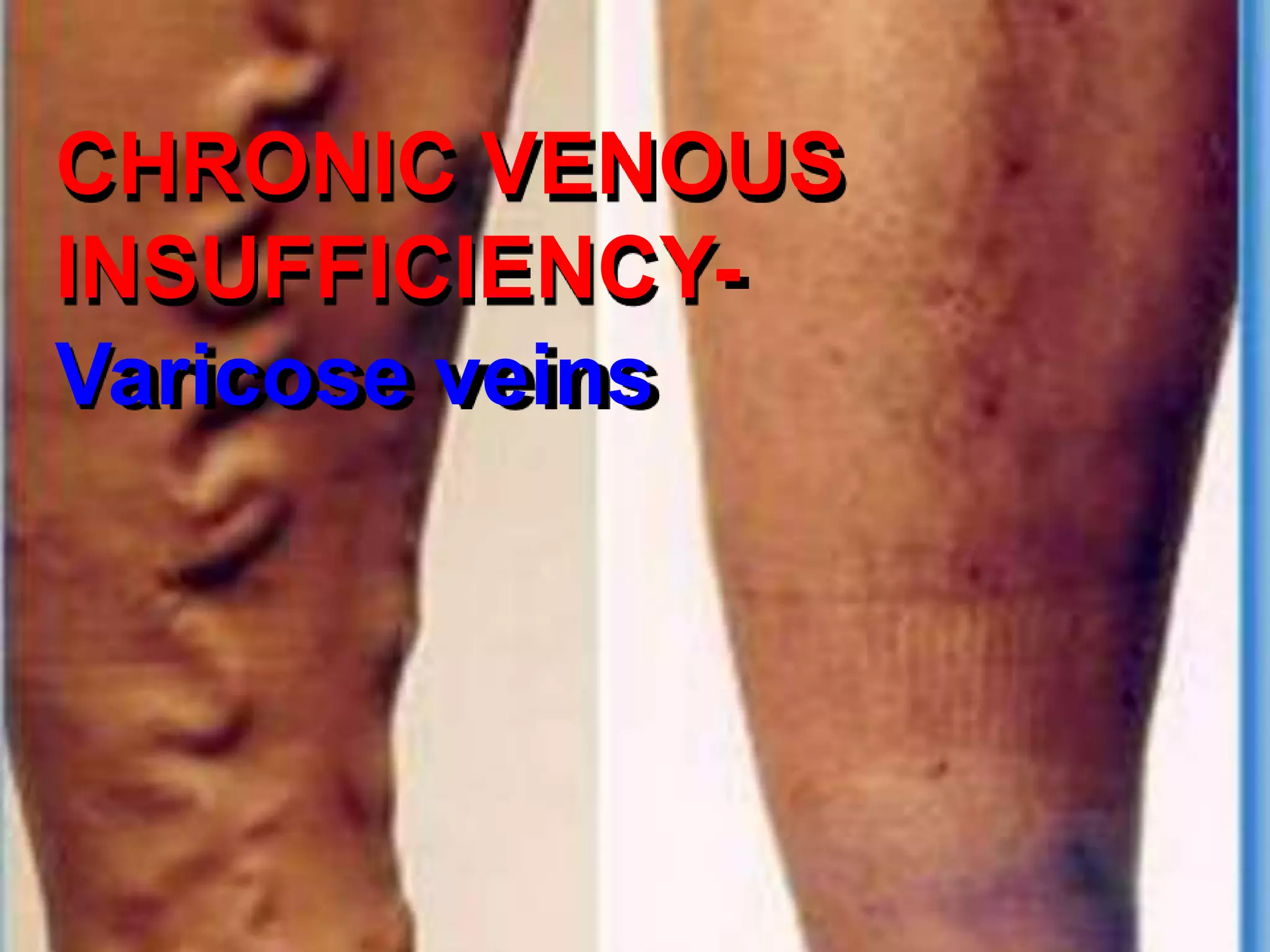 Varicose veins ppt | PPTX