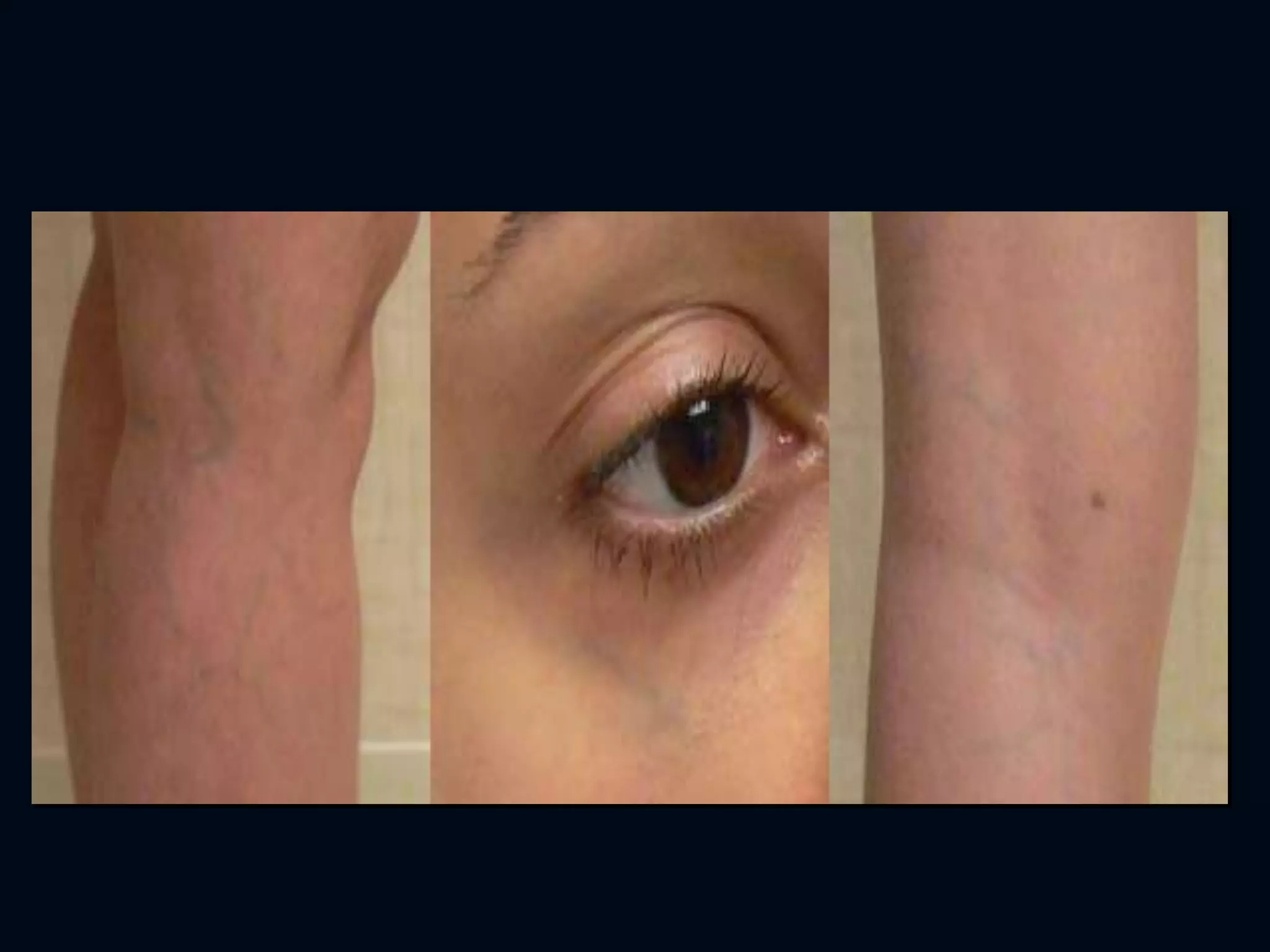 Varicose Veins Ppt Pptx