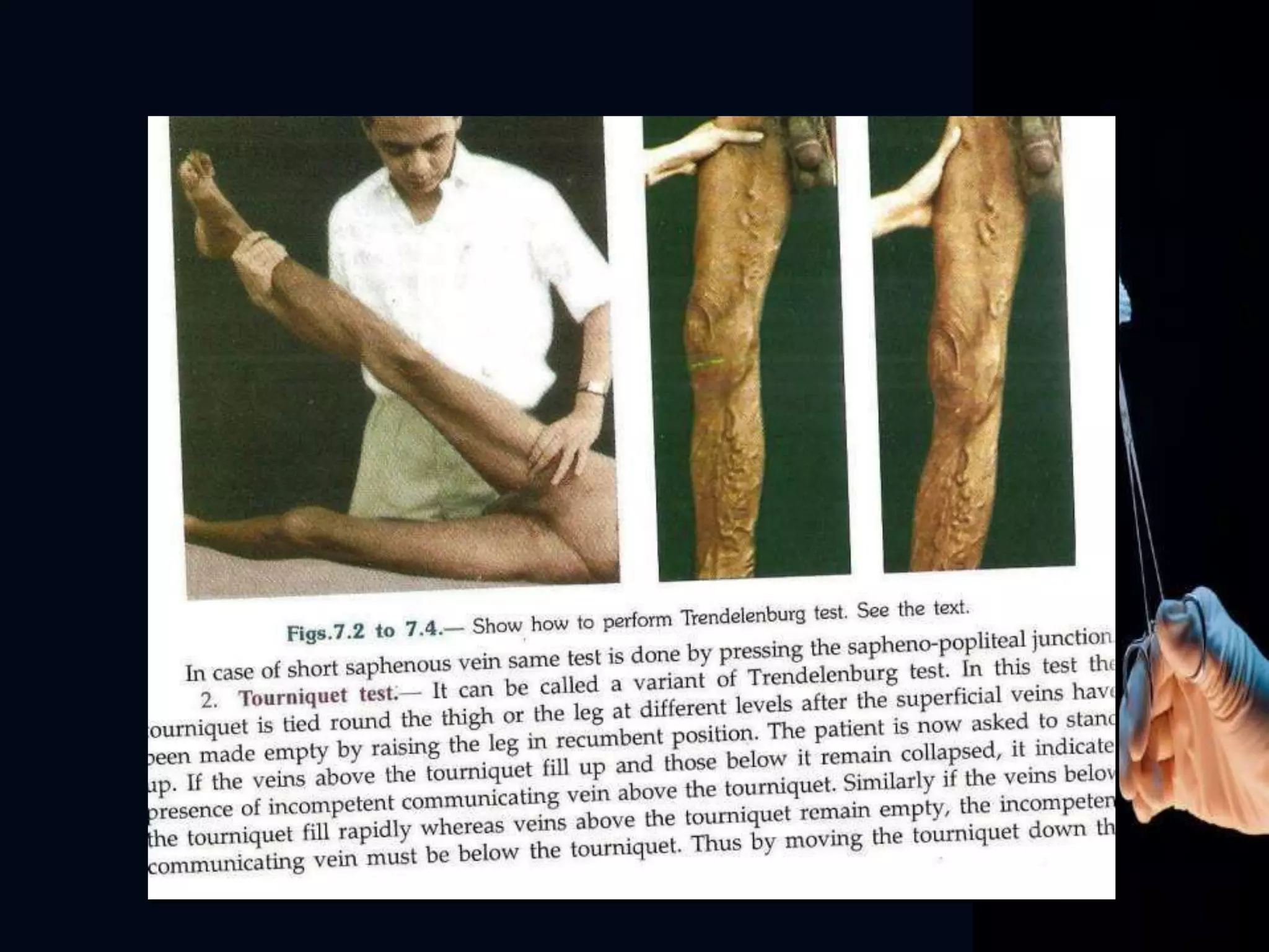 Varicose Veins Ppt Pptx