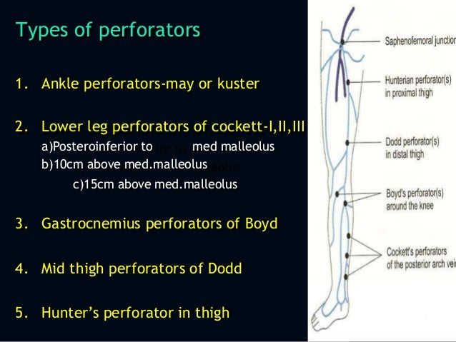 Varicose veins ppt