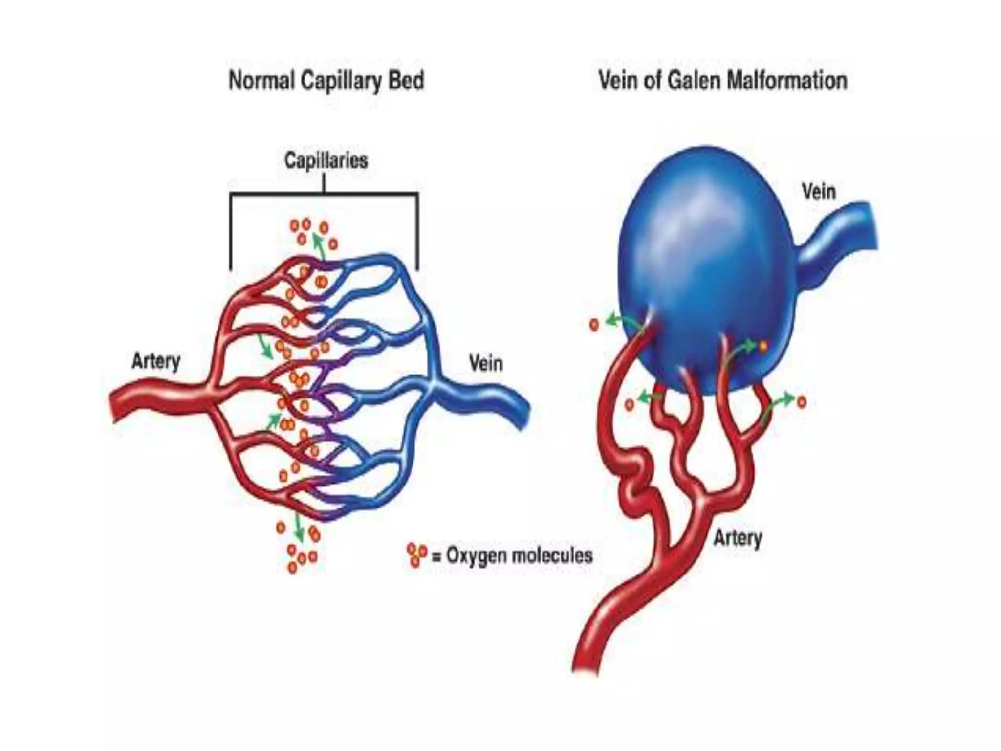 Vein of galen malformation | PPTX