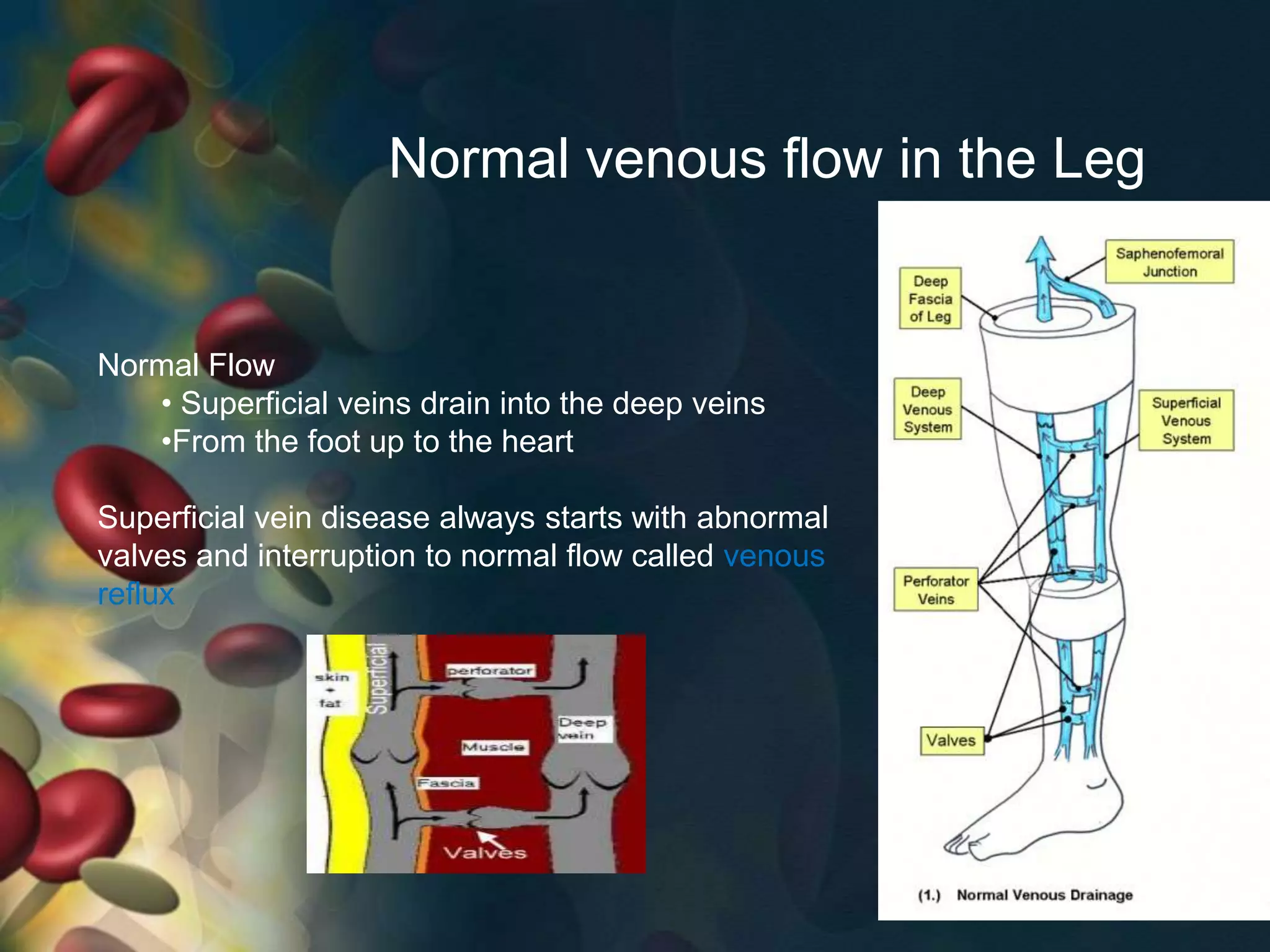 Varicose Veins | PPT | Free Download