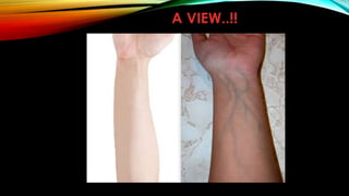 Vein viewing. | PPTX